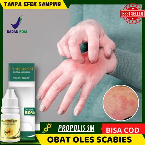 Jual Obat Jamur Scabies Jamur Koreng Obat Oles Scabies Scabies