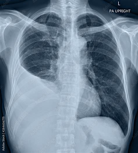 Film X Ray Chest Moderate Loculated Right Pleural Effusion Stock