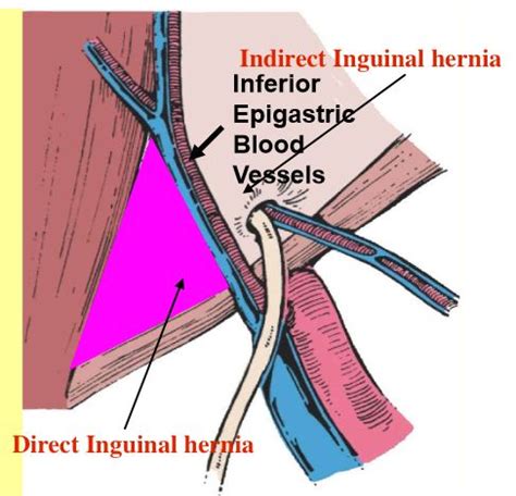 Inguinal Hernia Surgical Anatomy