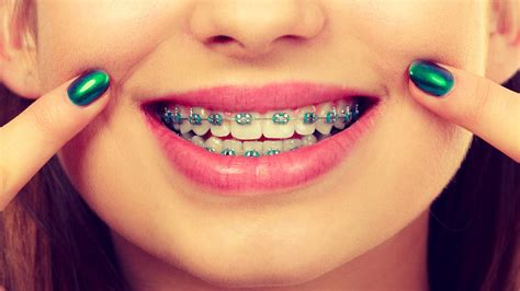 Brackets cómo cuidarlos y qué colores de ligas usar para que los