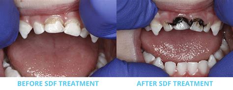 Apa Yang Dimaksud Dengan Silver Diamina Flouride SDF Ester Dental