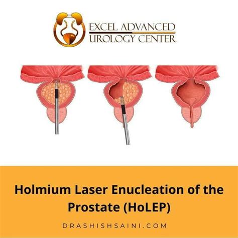 Holep Surgery Near You Dr Ashish Saini