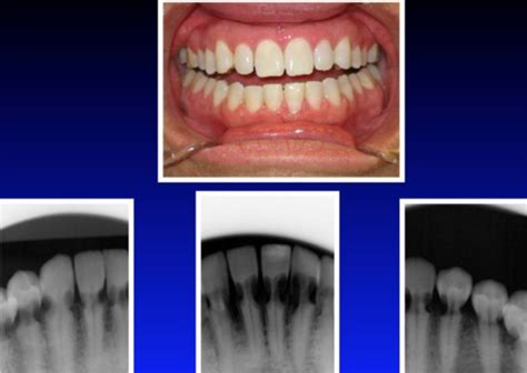 Path Teeth Abnormalities Flashcards Quizlet