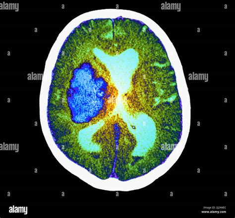 Cerebral Haemorrhage Ct Scan Stock Photo Alamy