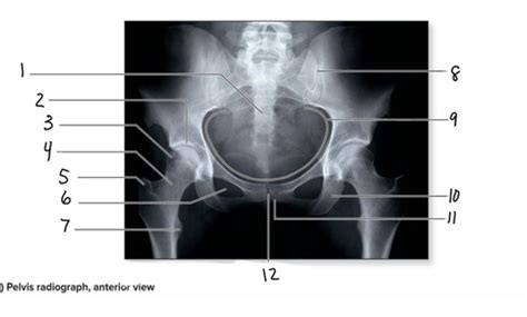 Chapter Pelvis Radiograph Anterior View Flashcards Quizlet