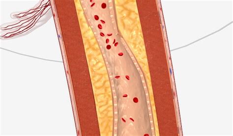 Premium Photo Narrowed Blood Vessel In Lower Extremity