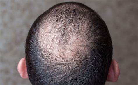 Alopecia Causada Por Estr S Tratamiento Grupo Milenio