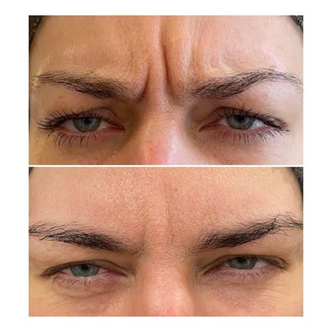 Usuwanie Lwiej Zmarszczki Botoksem Warszawa Bemowo Botox Na Lwi
