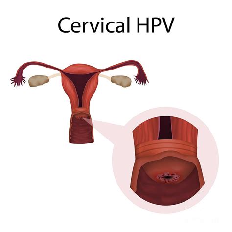 Cervical Hpv Infection Photograph By Veronika Zakharova Science Photo