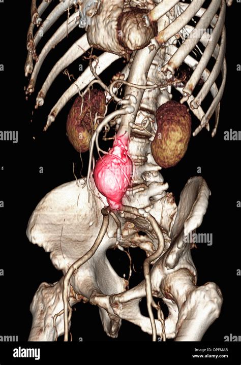 CT Scan Image Showing An Abdominal Aortic Aneurysm Stock Photo Alamy