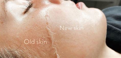 The Benefits Of Dermaplaning Glamor Medical