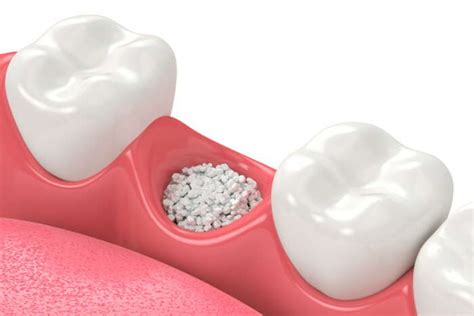 Pérdida de hueso dental Cuáles son sus soluciones
