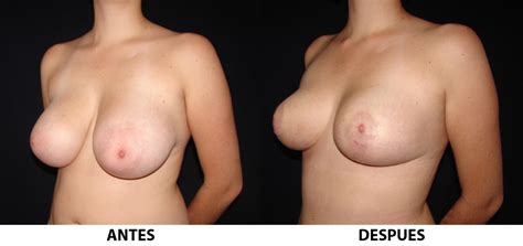 Mamoplastia Reductiva con pequeñas cicatrices para la corrección de