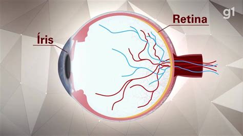 V Deo Veja Os Sinais De Retinoblastoma C Ncer Que Afeta Olhos Da