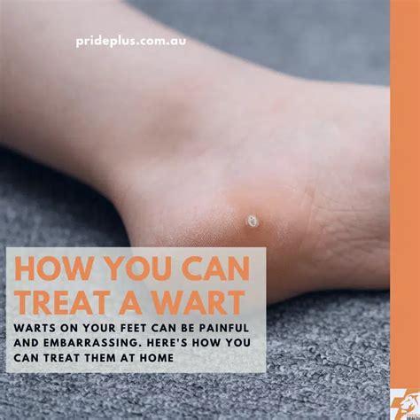 How To Get Rid Of Warts On Your Feet At Home 2 Options