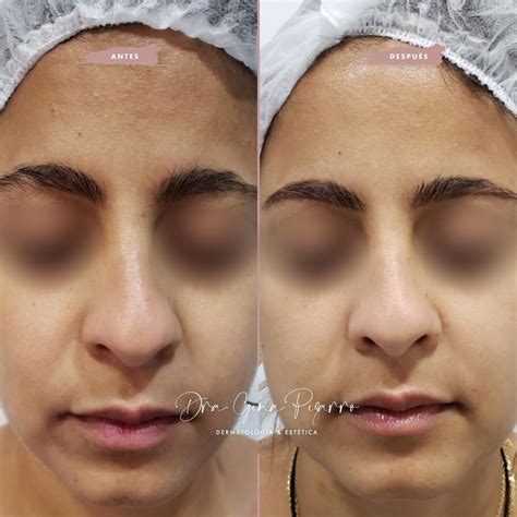 Plasma Rico En Plaquetas Microneedling Dra Gina Pizarro