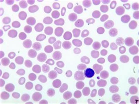 Hematology W W Medialabs Rbc Wbc Disorder Flashcards Quizlet
