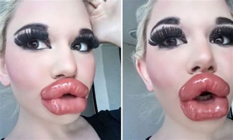 La donna con la labbra più grandi al mondo 26 botox per diventare una
