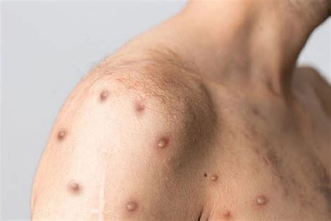 Tìm hiểu hình ảnh phát ban trên da hiv
