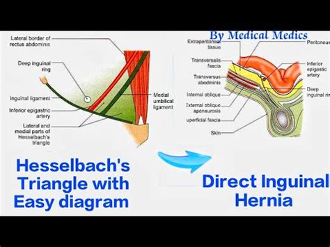 Hesselbach S Triangle Anatomy Of Inguinal Triangle Simplified