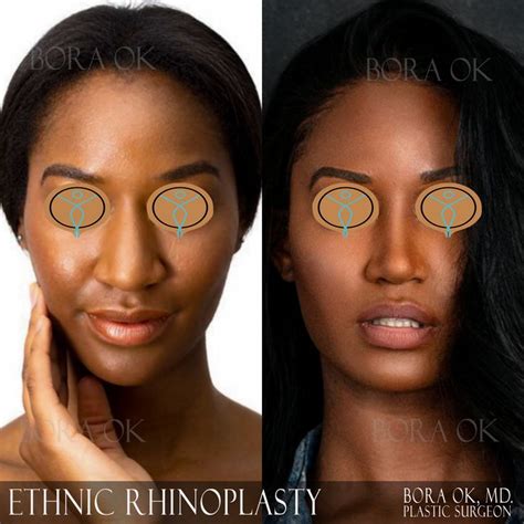 Ethnic Rhinoplasty African American Asian Nose Job Before After