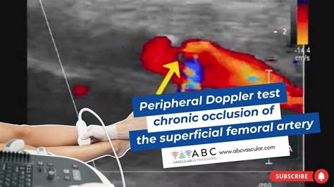 Femoral Artery A Femoralis The Arteries Of The Lower