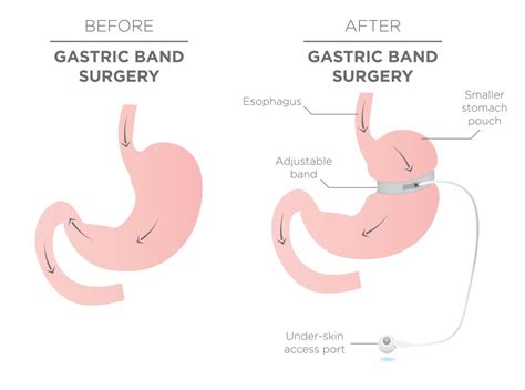 Adjustable Gastric Band Surgery