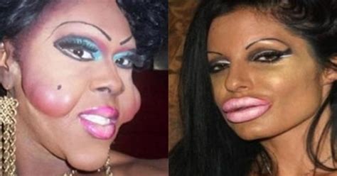 Confira 8 cirurgias plásticas desastrosas