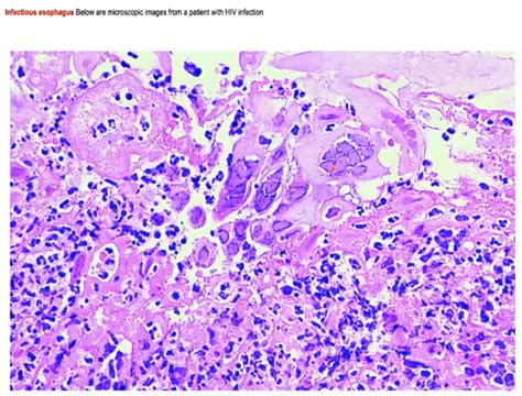 Herpes Simplex Case Diagram Quizlet