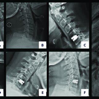 Sagittal Alignment Accuracy Of The Prosthesis Evaluated By X Ray This