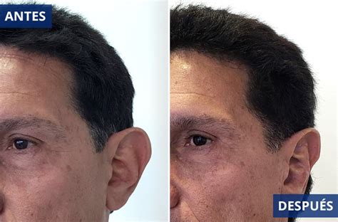 Otoplastia Antes Y Despu S Dr Nelson Chaves