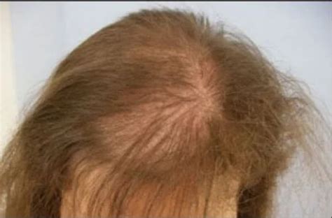 Female Telogen Effluvium Causes Symptoms And Treatment Justinboey