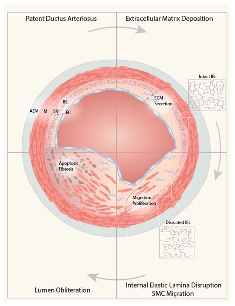 Patent Ductus Arteriosus Pathophysiology