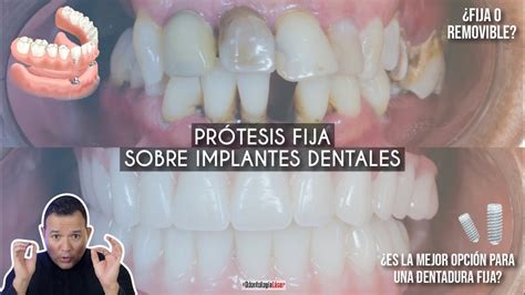 Prótesis fija sobre Implantes dentales La mejor opción para volver a
