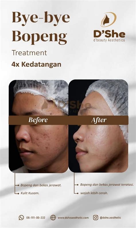 Cream Untuk Mengecilkan Pori Pori Bekas Jerawat Homecare24