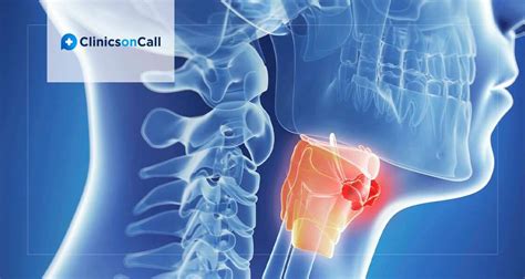 All You Need To Know About Throat Cancer Clinics On Call