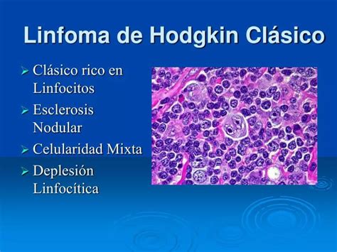 PPT Linfoma de Hodgkin Clásico PowerPoint Presentation free download