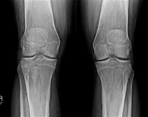 A Year Old Man With Debilitating Hip Pain Jbjs Image Quiz
