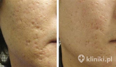 Laserowe usuwanie blizn zdjęcia przed i po Kliniki pl