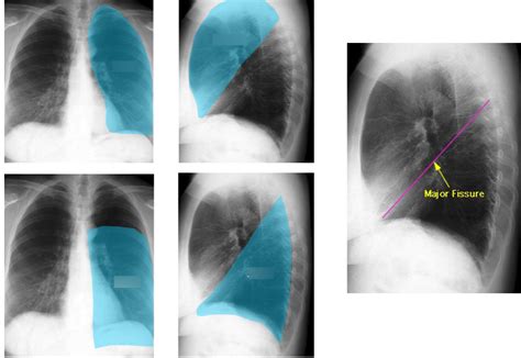 Pathophysiology Left Lung Diagram Diagram Quizlet