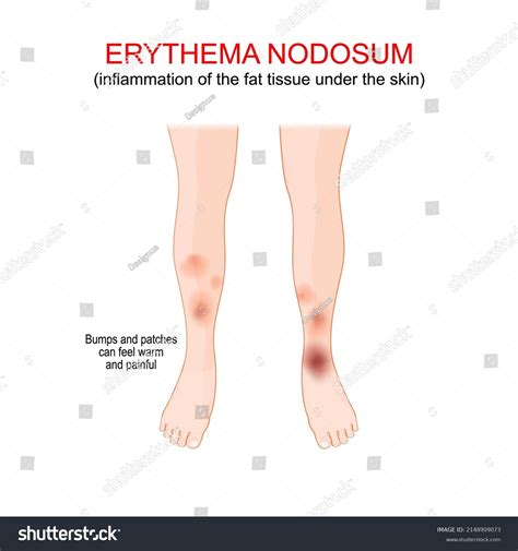 Erythema Nodosum Inflammation Fat Tissue Under Stock Vector Royalty