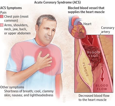 Procalcitonin A New Biomarker For The Cardiologist BioVendor R D