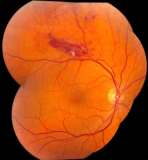 Whitman Images BRVO Branch Retinal Vein Occlusion