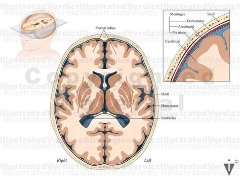 Stock Brain Hydrocephalus Shunting Illustrated Verdict