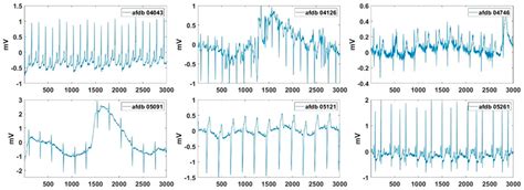 sensors free full text an adaptive median filter based on sampling rate for r peak detection