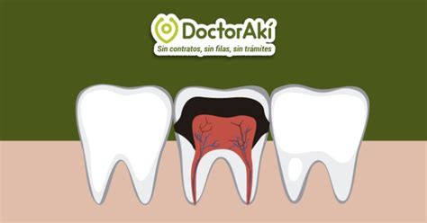 Qué es la Pulpitis Tipos signos y causas DoctorAkí