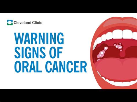 Oral Cancer Signs Symptoms And Self Screening SchoolTube
