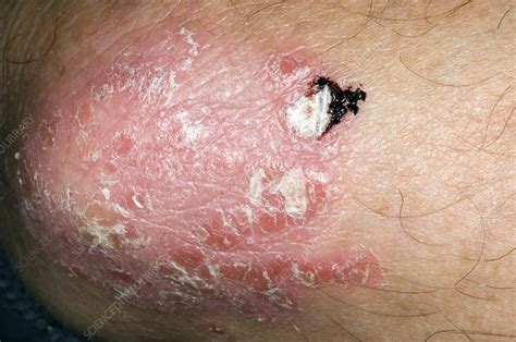 Plaque Psoriasis Of The Elbow Stock Image C002 9648 Science Photo