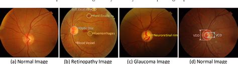 figure 1 from multi scale and multi branch convolutional neural network for retinal image