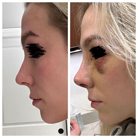 Rhinoplasty Cast Removal 1 Week Post Op Rplasticsurgery